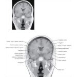 Coronal Sections Through the Forebrain: Level 3 - Anterior Commissure ...