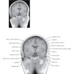 Coronal Sections Through the Forebrain: Level 4 - Amygdala, Anterior ...