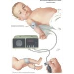 Measurement of Blood Pressure In Infants (Ultrasound Method)