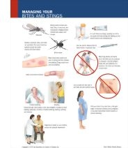 Managing Your Bites and Stings