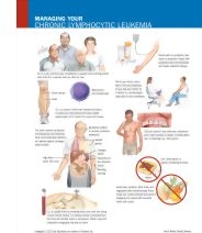 Managing Your Chronic Lymphocytic Leukemia