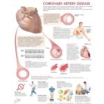Coronary Artery Disease