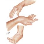 Paralysis Agitans: Hand and Foot Changes