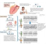 Sudden Cardiac Death