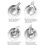 Superior Labrum Anterior and Posterior (SLAP) Injury