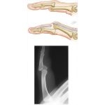 Proximal Interphalangeal (PIP) Joint Dislocation