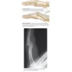 Proximal Interphalangeal (PIP) Joint Dislocation