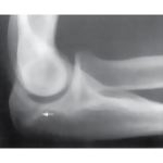 Lateral Elbow, Olecranon Stress Fracture