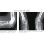 Osteochondral Lesion of the Capitellum
