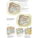 Endolymphatic: Subarachnoid Shunt for Meniere's Disease