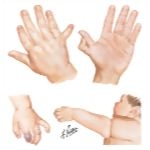 Pediatric Disorders of the Hand