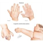 Pediatric Disorders of the Hand