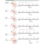 Premature Contractions