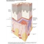 Burn Wound Healing With Xenograft Used As Biologic Dressing