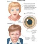 Developmental Glaucoma