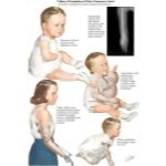 Failure of Formation of Parts: Transverse Arrest (Forearm amputation ...