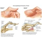Deformities of the Thumb Ray