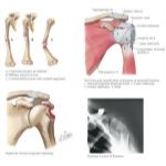 Fractures of the Humerus