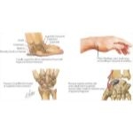 Fracture of Scaphoid