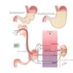 Pyloric Obstruction and the Effects of Vomiting