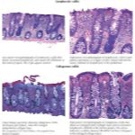 Microscopic Colitis: Lymphocytic and Collagenous