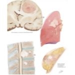 Tumors Metastatic to Brain and Spine