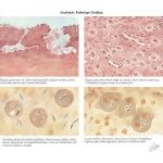 Amebiasis: Pathology and Diagnosis
