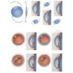 Cataracts Intraocular Lens (IOL)