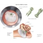 Short-Term Middle Ear Aeration