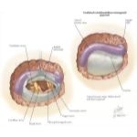 Vestibular Nerve Section