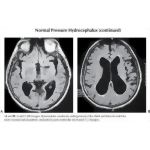Normal Pressure Hydrocephalus