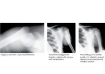Remodeling of Fracture of Proximal Humerus In a Child