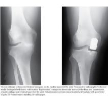 Unicondylar Knee Arthroplasty