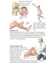 Rupture of Anterior Cruciate Ligament (ACL)