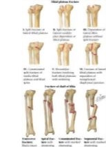 Tibial Fractures