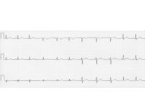Normal Electrocardiography (ECG)
