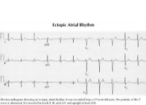 Ectopic Atrial Rhythm