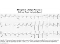 ST-Segment Changes Associated With an Acute Ischemic Event