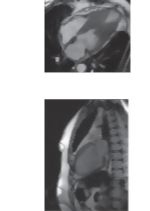 Cardiac Magnetic Resonance Imaging (MRI)