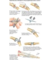 Implant Resection Arthroplasty for Metacarpophalangeal Joints