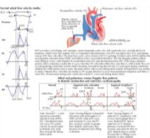 Doppler Flow Studies: Comparison of Mitral and Pulmonary Vein Flow ...