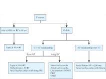 Diagnosis of Narrow-Complex Supraventricular Tachycardia