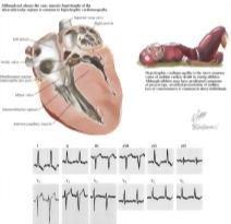 Sudden Death In Hypertrophic Cardiomyopathy