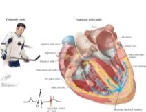 Mechanism of Sudden Cardiac Death In Commotion Cordis
