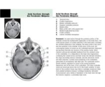 Axial (Horizontal) Sections Through the Forebrain: Level 1 - Mid Pons