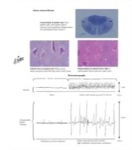 Primary Motor Neuron Disease