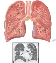 Bronchiectasis