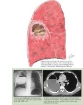 Lung Abscess