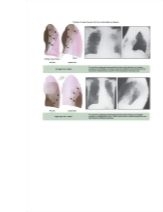 Patterns of Lobar Collapse; Left Lung (after Lubert and Krause)