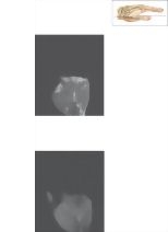 Cross Section of the Hand and Finger: Coronal View